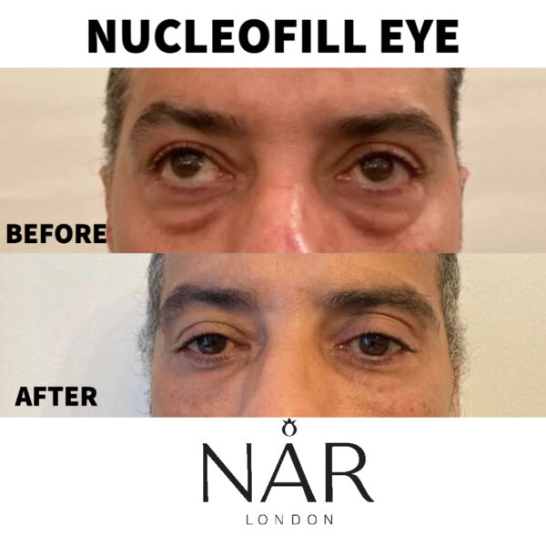 NUCLEOFILL EYES LONDON | Eye Bags Treatment | NAR LONDON Harley Street
