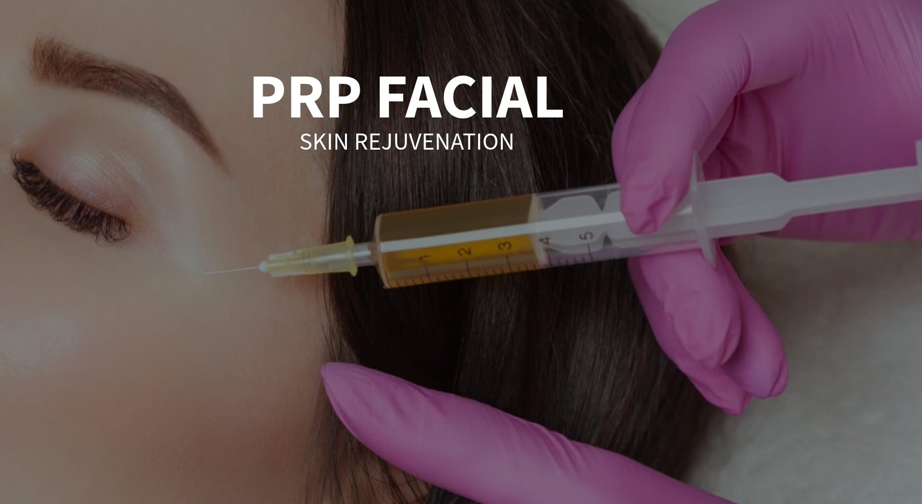 Best PRP Facial London | Vampire Facial | Skin | NAR LONDON